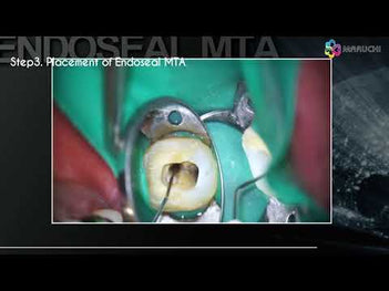 Root canal Repair EndoCem MTA & EndoSeal Premix MTA